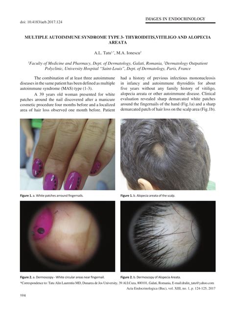 Pdf Multiple Autoimmune Syndrome Type 3 Thyroiditis Vitiligo And Alopecia Areata