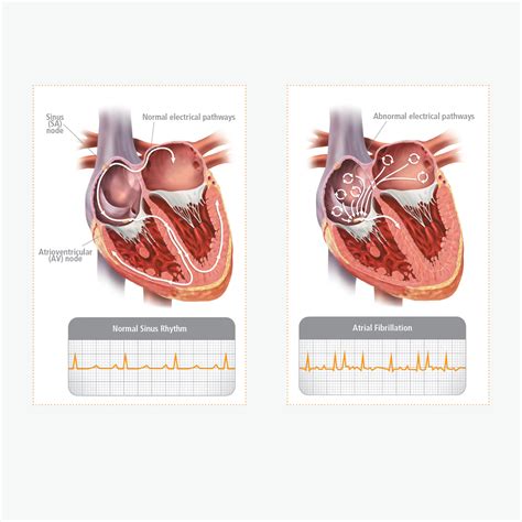 Atrial Fibrillation Definition Mvgnse
