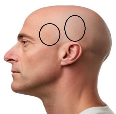 Transcranial Electrical Stimulation Therapy In Speech Disorder Aphasia