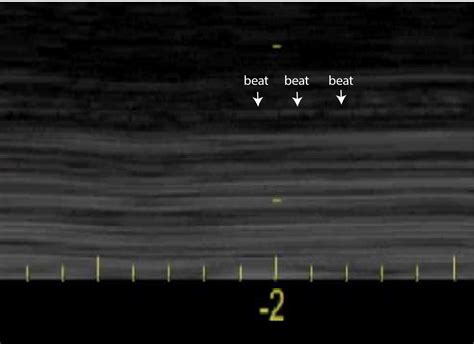 4 Case Of The Month Ectopic Pregnancy Critical Care Sonography
