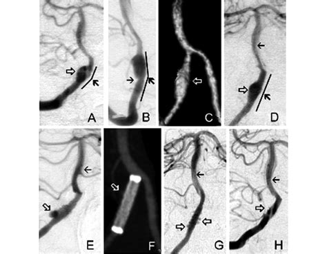 Case 4 Images Showing A Dissecting Aneurysm Of The V4 Segment Of The
