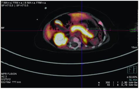 Diffuse Form Of Chi In F Dopa Pet Of Our Patient Diffuse Form Of Chi