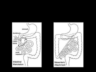 Clinical Case Asr Laparoscopic Ladds Procedure For Malrotation