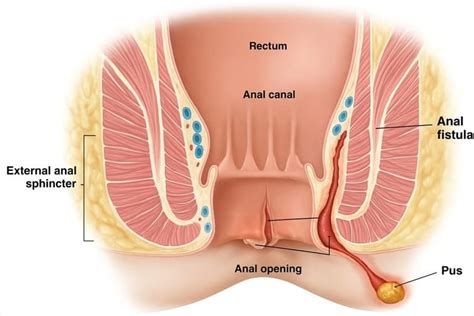 Permanent Anal Fistula Treatment In Delhi Delhi Fistula Clinic