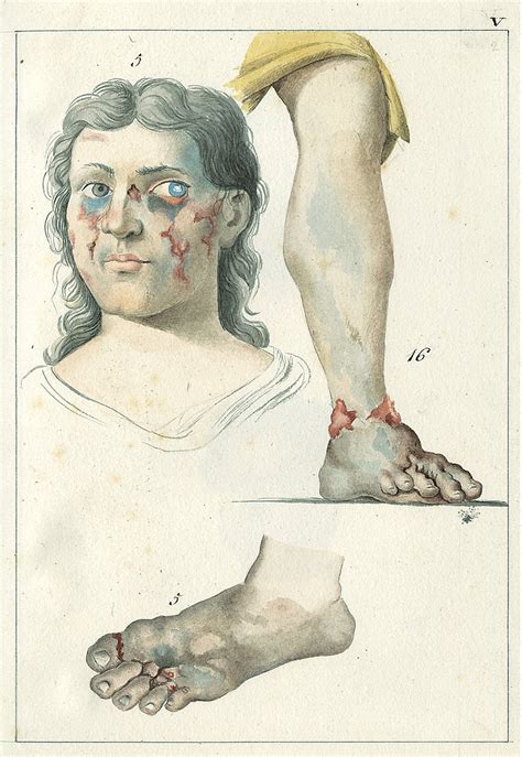 Lower Extremity Amputation Compound Fractures Free Photo Illustration