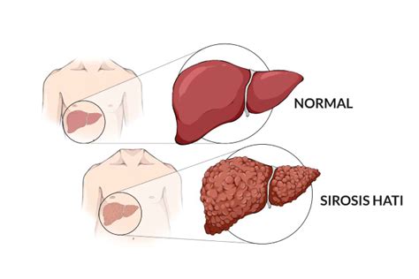 Sirosis Gejala Penyebab Dan Mengobati Alodokter