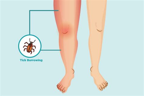 Lyme Arthritis Symptoms And Treatment