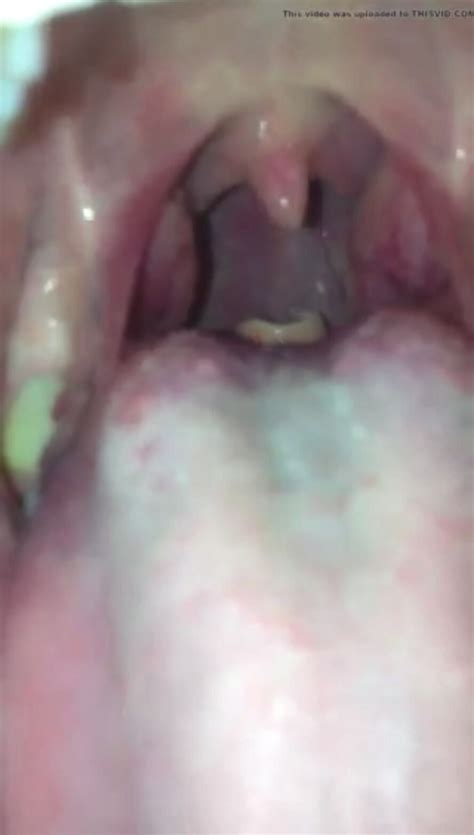 Girl Big Tonsil And Epiglottis Vore Gag