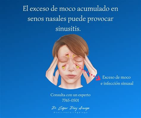 La Sinusitis Se Presenta Por La Acumulación De Moco En Los Senos
