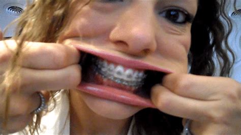 Aubrey Chase Brace Face