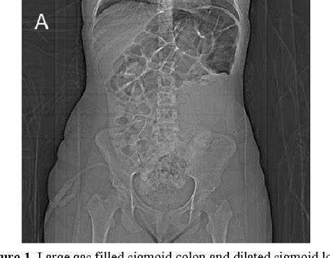 Figure 1 From A Rare Case Of Splenic Torsion With Sigmoid Volvulus In A