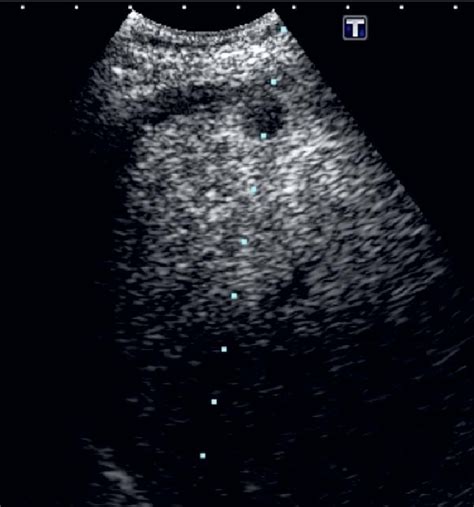 Figure 1 From Radiofrequency Ablation Guided By Contrast Enhanced
