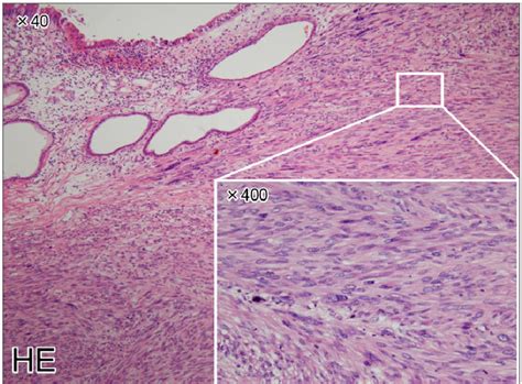 Tumor Cells Are Arranged In Fascicles Of Spindle Cells He Stain