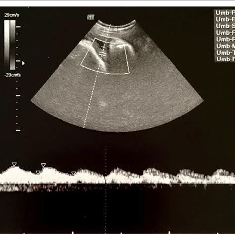 Biological Prosthesis Aortic Valve Pressure Gradient Download