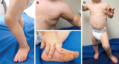 Proteus Syndrome