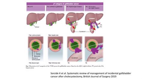 Approach And Management Of Incidental Carcinoma Gallbladder Pptx