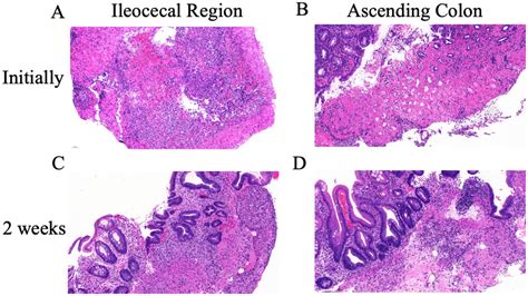 Frontiers Ischemic Colitis Presenting As A Colonic Mass A Case