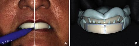 Workflow For Complete Dentures Fabrication In Three Appointments A