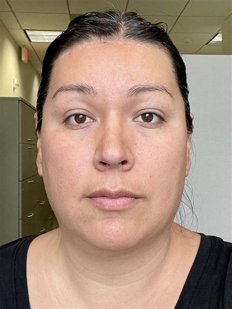 1 Year Post Ffs Dr James Lee Kaiser West La Rtransgendersurgeries