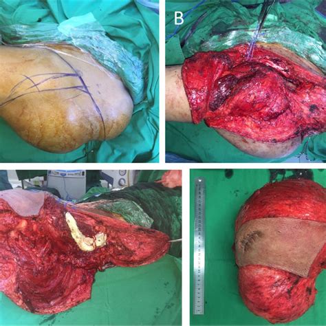 A Plain Radiograph Revealed Popcorn Calcification Download Scientific Diagram