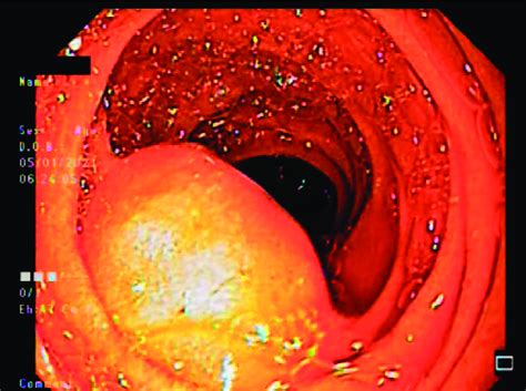 Esophagogastroduodenoscopy Egd A D3 Mass That Occupies 50 Of The Download Scientific