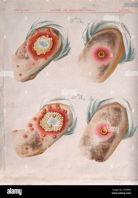 Vintage Illustration Of A Comparison Between Smallpox And Cowpox