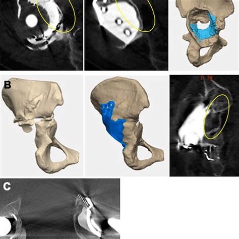 A Ct Scans And 3d Reconstructions Showing Medial Acetabular Defect