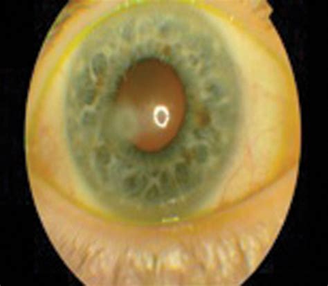 Fusarium Keratitis In A Patient With Alcohol Dependence Eye News