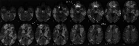 Statistical Parametric Map Overlaid On A Magnetic Resonance Image