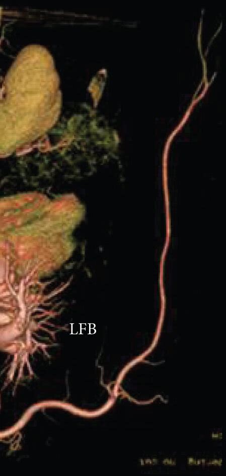 GCA Model Of Nude Mouse Subject To Enhanced CT Scan A Enhanced CT