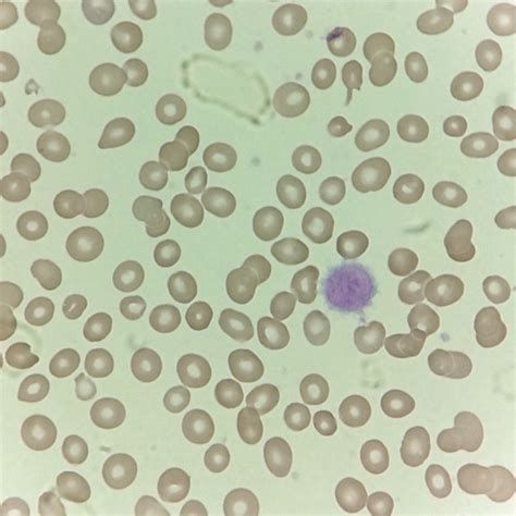 Platelets Giant And Large Clots And Clumps