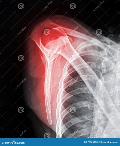 X Ray Shoulder Joint Shoulder Transcapular View For Diagnosis Fracture