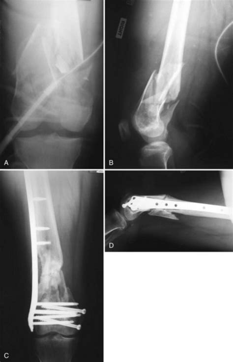 Distal Femur Fractures Musculoskeletal Key