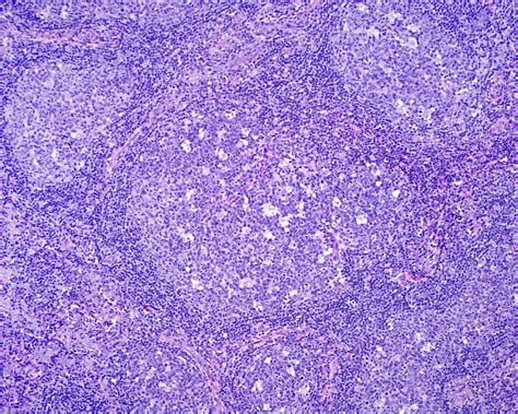 Pathology Outlines Reactive B Cell Rich Lymphoid Proliferations That