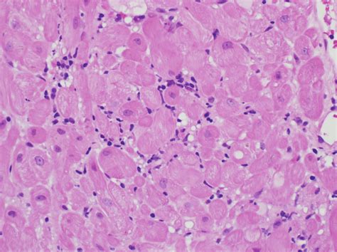 High Power View Of The Endomyocardial Biopsy Showing Patchy Lymphocytic