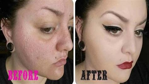 Bee Sting Cellulitis Antibiotics Of Choice