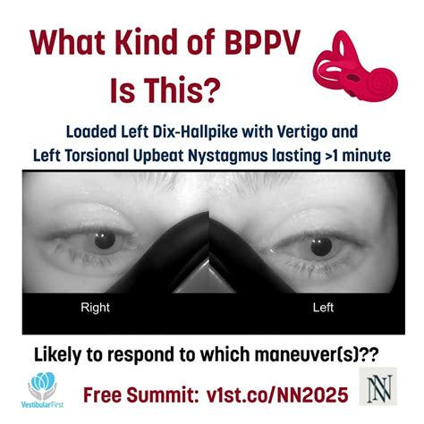 Posterior Cupulolithiasis Bppv Youtube