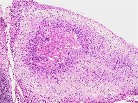 Head And Neck Case Review 2023 01 North American Society Of Head And Neck Pathology