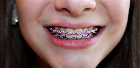 Purple Colored Braces