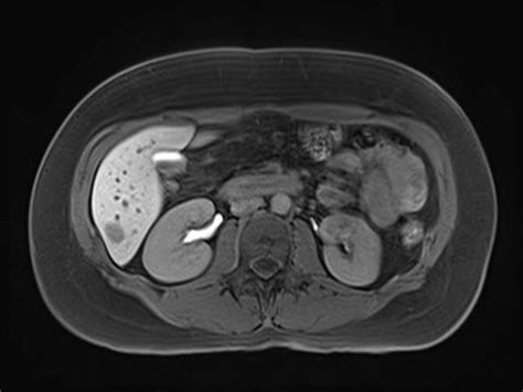 Hemangioma Eovist Radiology At Evelyn Ayala Blog Hemangioma Eovist Radiology At Evelyn Ayala Blog