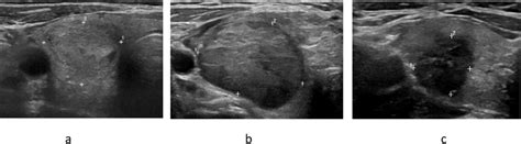Us Images In Different Sonographic Pattern A Right Thyroid Solid
