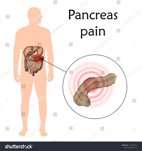 Pancreas Pain Inflammation Pancreatitis Anatomy Vector เวกเตอร์สต็อก