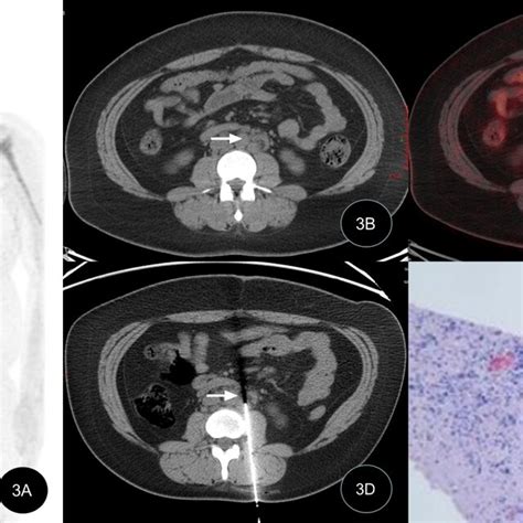 Petct Guided Targeted Retroperitoneal Masses Download Scientific