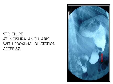 The Role Of The Incisura Angularis In Sleeve Gastrectomy Ppt Download