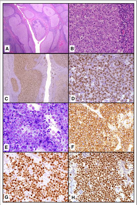 Figure 1 From The Updated Who Classification Of Hematological