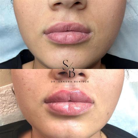 ტუჩის გადიდება ფილერი ბოტოქსი Dr Sandra Benidze • Instagram