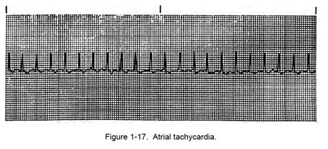 1 08 Atrial Rhythms Cardiac Rhythm Interpretation