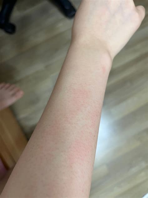 바디쉐이버 제모 후 염증 반응 지식in