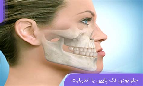 جلو بودن فک پایین و درمان آن با ارتودنسی