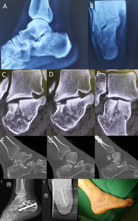 Case 1 Male 39 Years Old Who Fell From A Ladder X Ray Showed A Download Scientific Diagram